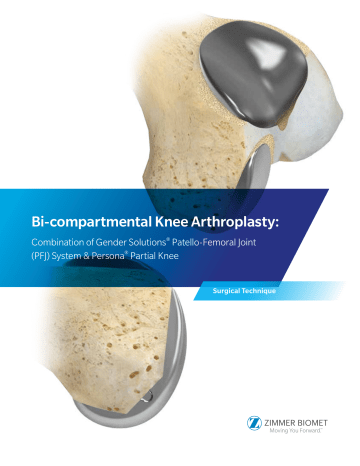 Inserting the IM Anterior Cut Guide with Telescoping Boom. Zimmer ...