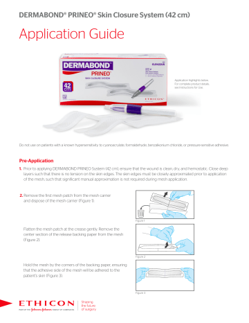 Ethicon DERMABOND PRINEO Application Manual | Manualzz